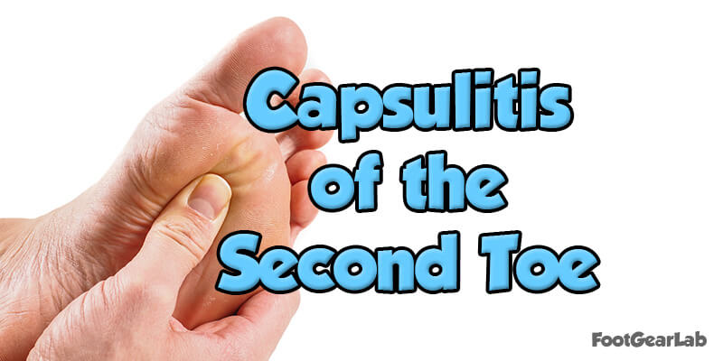 Capsulitis Of The Second Toe: Causes, Symptoms, And Treatments