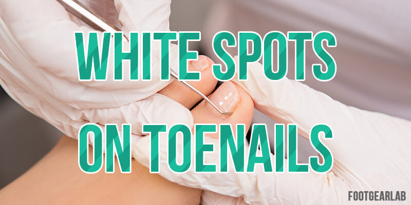 White Spots On Toenails Its Nature Causes Prevention And Treatment