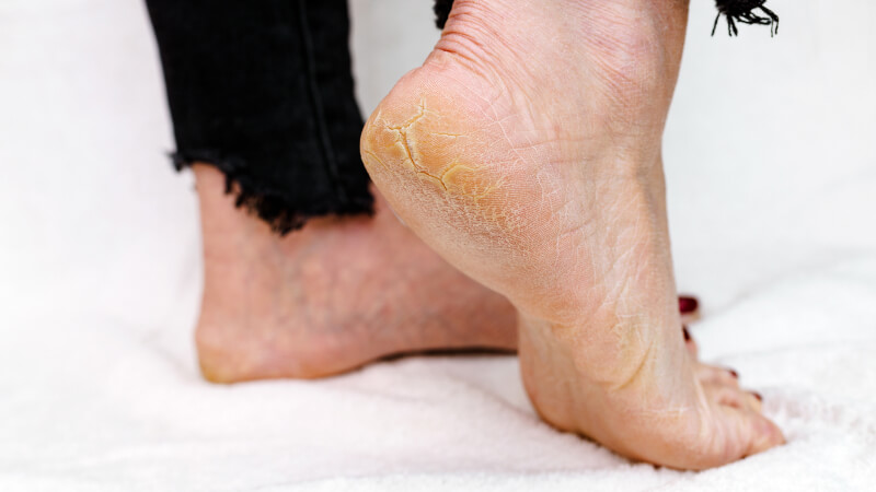 How To Prevent And Treat Cracked Heels - FootGearLab