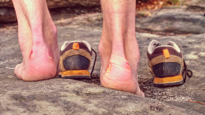 How To Avoid And Treat Blisters From Running - FootGearLab