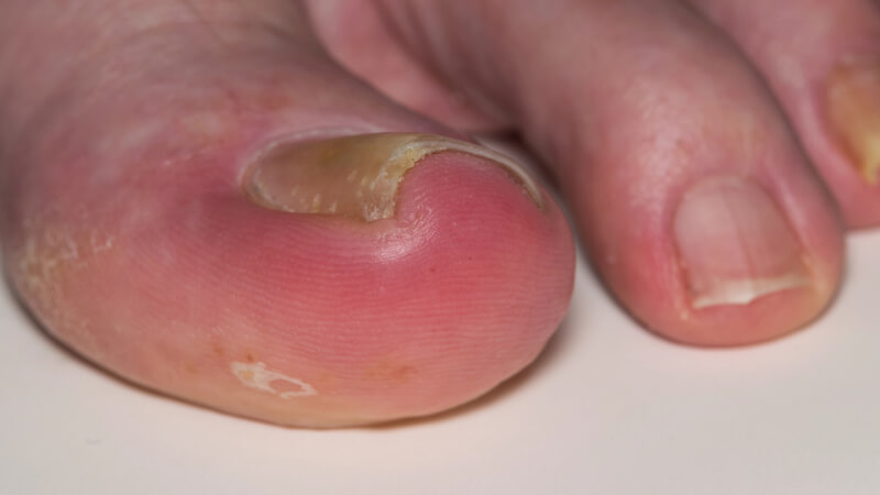 Ingrown Toenail Prevention And Treatment - FootGearLab